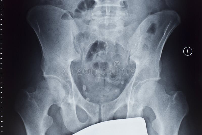 X-ray stock photo. Image of groin, pain, pelvic, acetabulum - 27036326