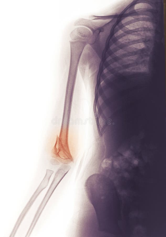 X-ray, 4 Year Old Boy, Fracture of Distal Humerus Stock Image - Image ...