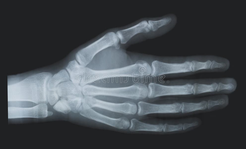 X-ray stock image. Image of hand, diagnosis, desease, anatomy - 466595