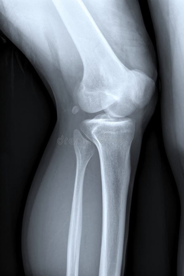 X-ray stock image. Image of fibula, skeleton, parts, tibia - 6680633