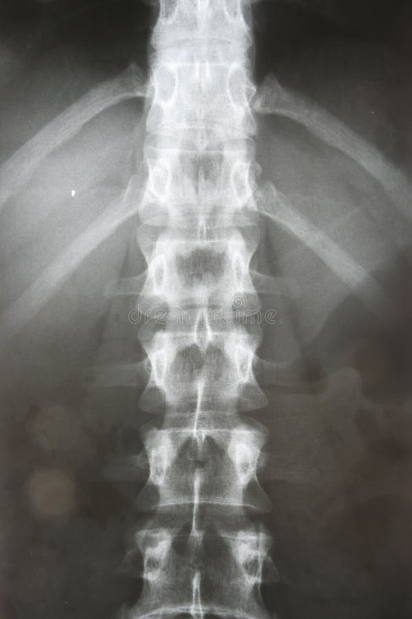 Lumbar Spine X-ray, Lower Back Stock Photo - Image of herniation, lower ...