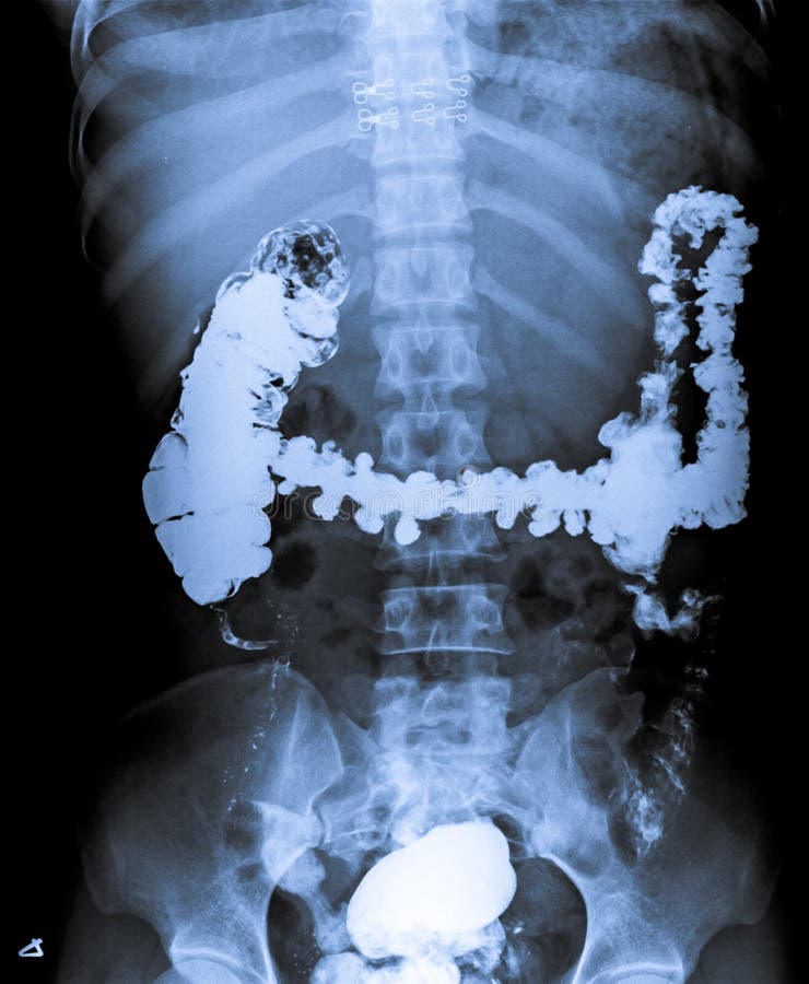 X Ray of Abdomen with Large Intestine. Stock Photo - Image of pelvis ...