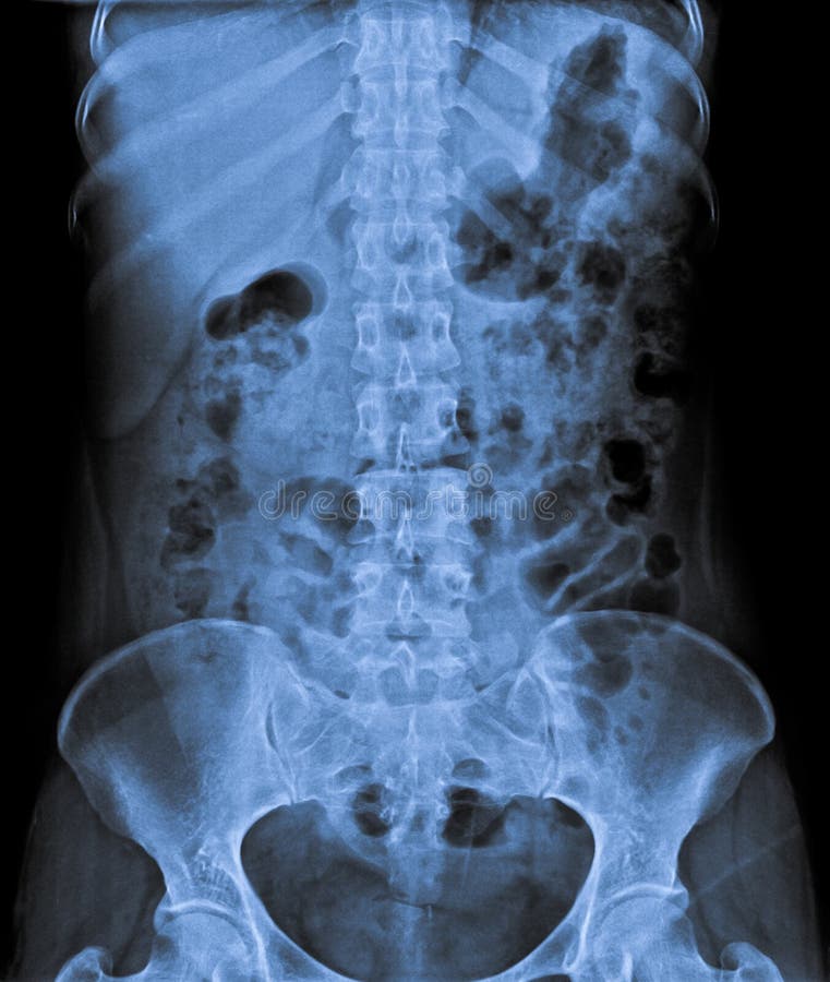 Abdomen X-Ray stock image. Image of groin, bone, forensic - 47516409
