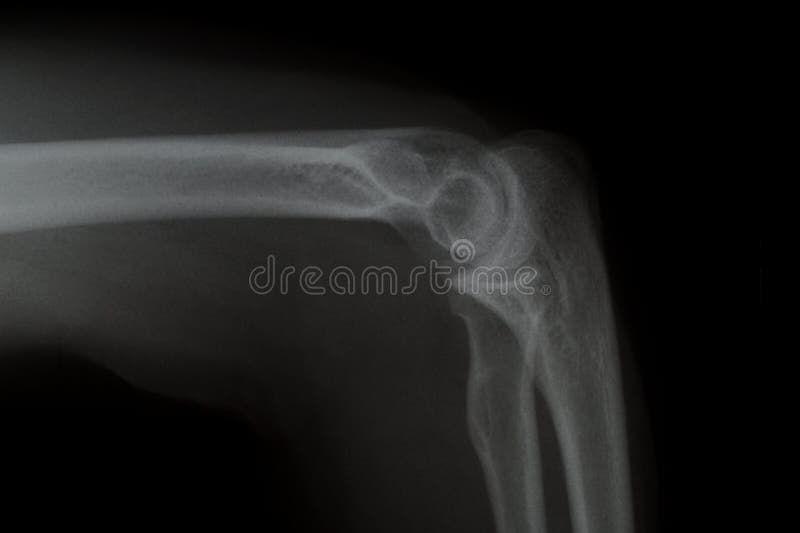 X ray af Elbow stock image. Image of isolated, parts - 55224189