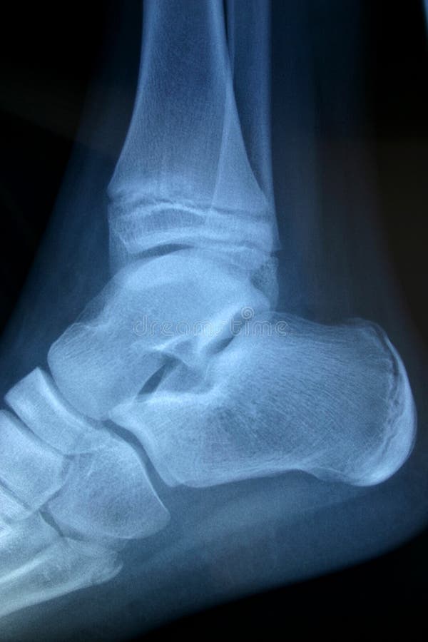 X-ray ankle stock photo. Image of break, ankle, pain, large - 803336