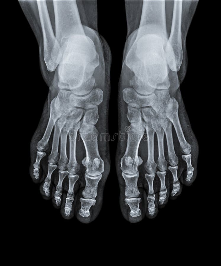 X Ray of Ankle Joint Front View. Stock Image - Image of operation ...