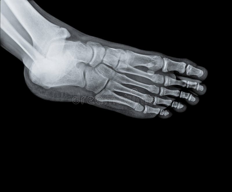 X Ray of Ankle joint stock image. Image of investigation - 74660727