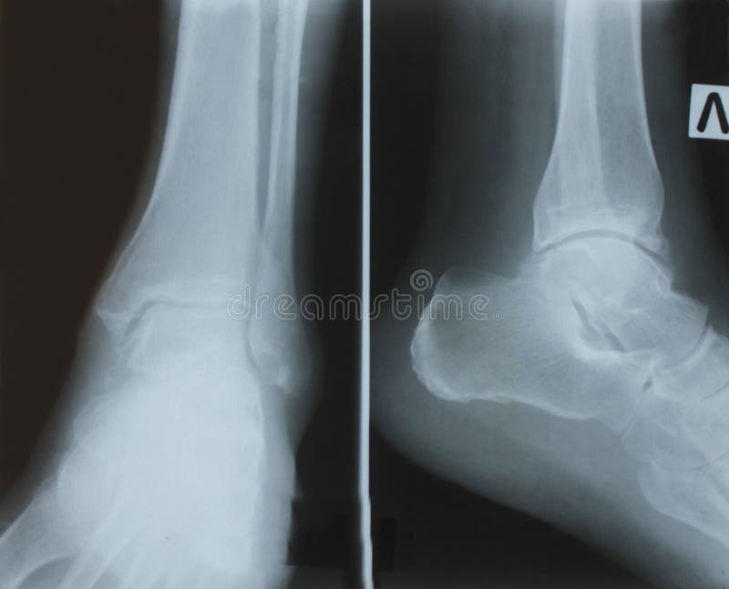 X-ray Ankle Joint with Osteoarthritis Stock Image - Image of ...