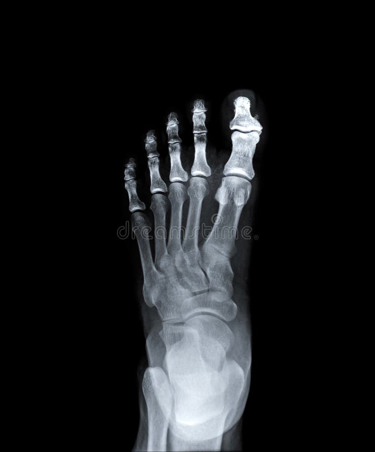 X Ray of Ankle Joint Top View. Stock Photo - Image of front, foot: 92313634