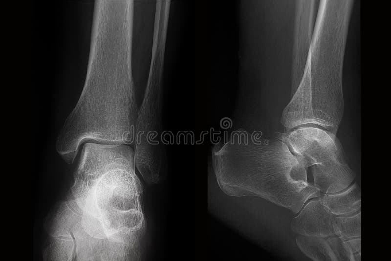 Plain Film X-ray of Ankle in Two Projections, Radiography Stock Image ...