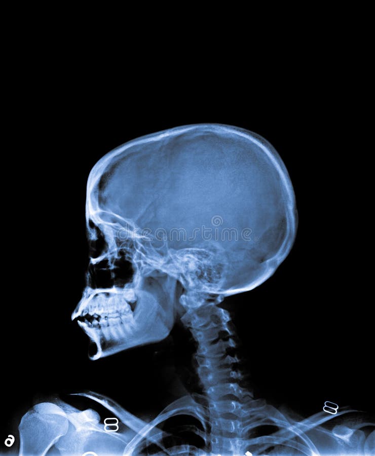 X Ray av skallen fotografering för bildbyråer. Bild av kopiering - 74641611