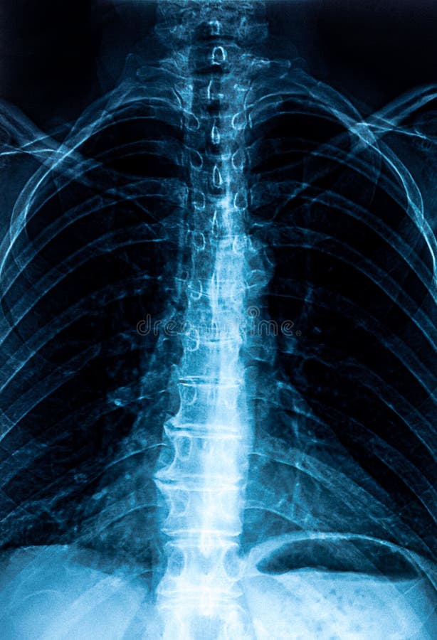 2,550 X Ray Back Stock Photos - Free & Royalty-Free Stock Photos from ...