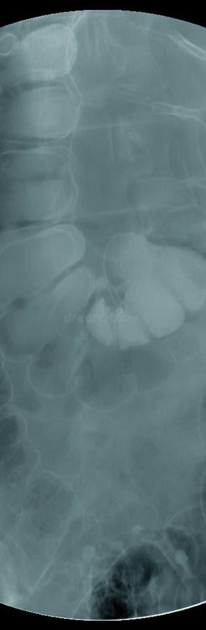 X-ray Barium Enema Examination (lower Gastrointestinal Stock Image ...