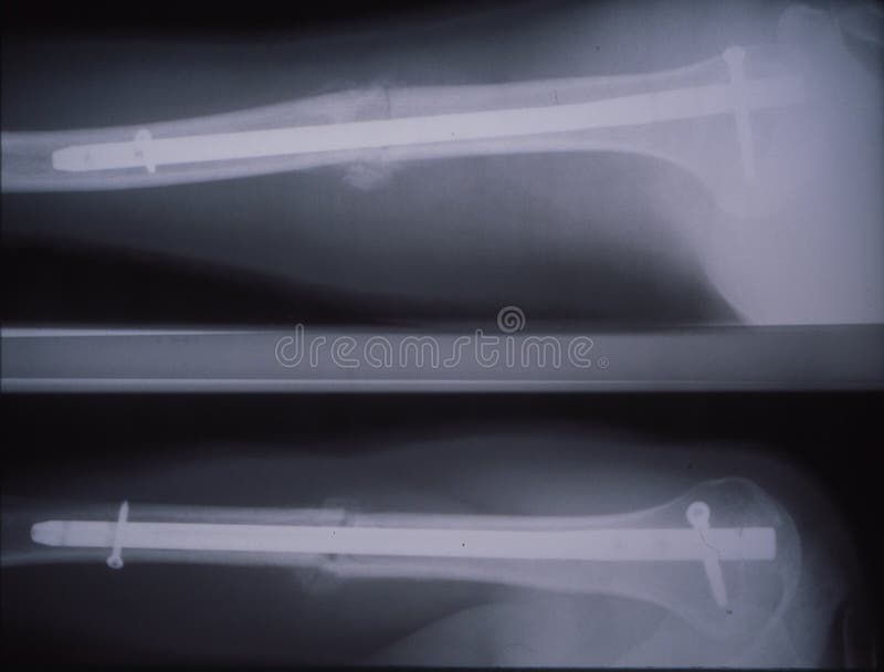 X-ray of the Brachial Bone. Helical Humeral Fracture. Negative Stock ...