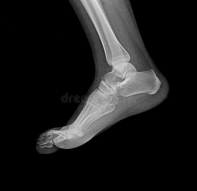 X-ray of the Bones of the Human Lower Limb Stock Image - Image of ...