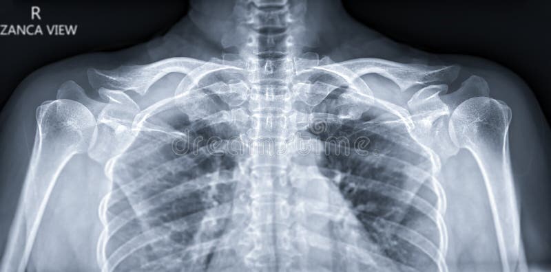 X-ray of Both Clavicle Zanca View for Diagnosis Fracture of Clavicle ...