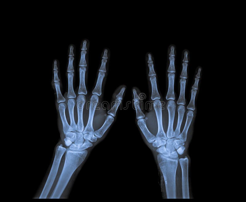 X Ray of both hand. stock image. Image of right, diagnosis - 74641415