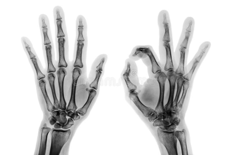 X-ray Both Hands with OK Sign Stock Image - Image of medicine, finger ...
