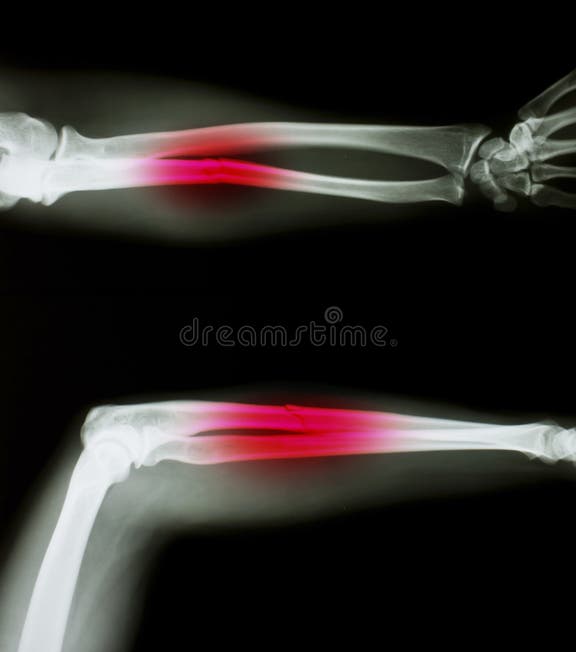 X-ray of Both Human Arms Medical . Stock Image - Image of radiology ...