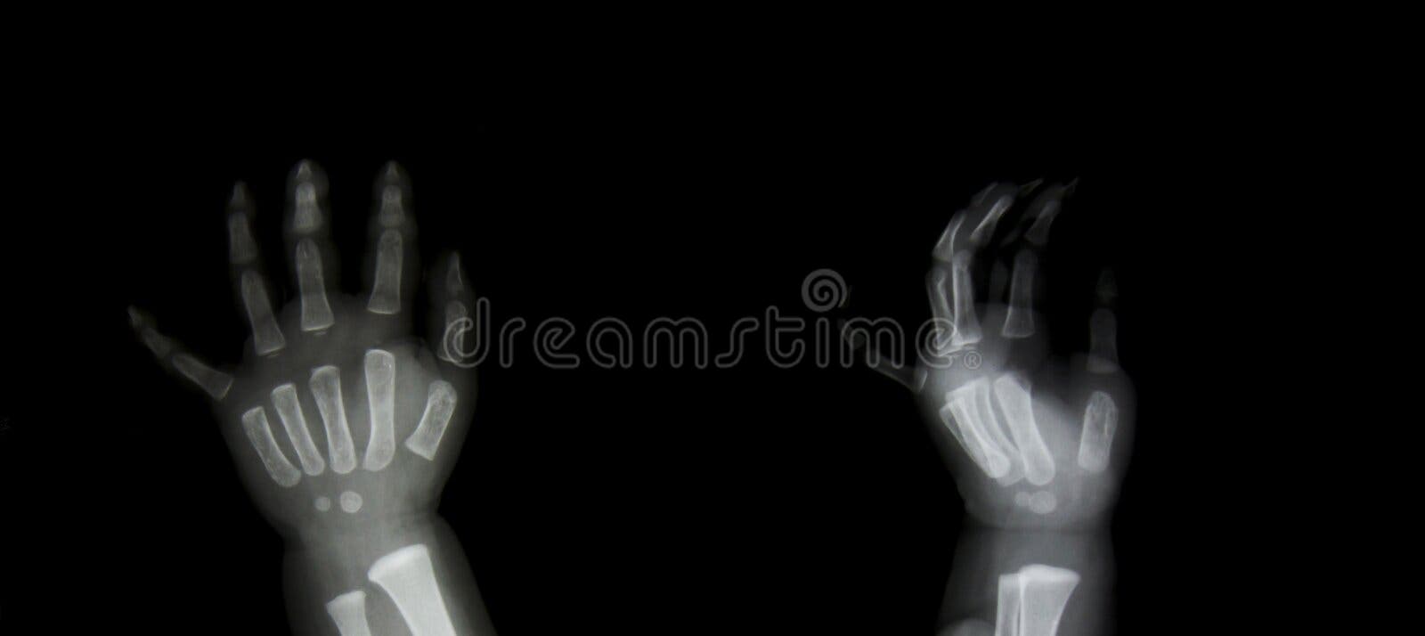 X-ray of both human legs stock photo. Image of clinical - 53766062