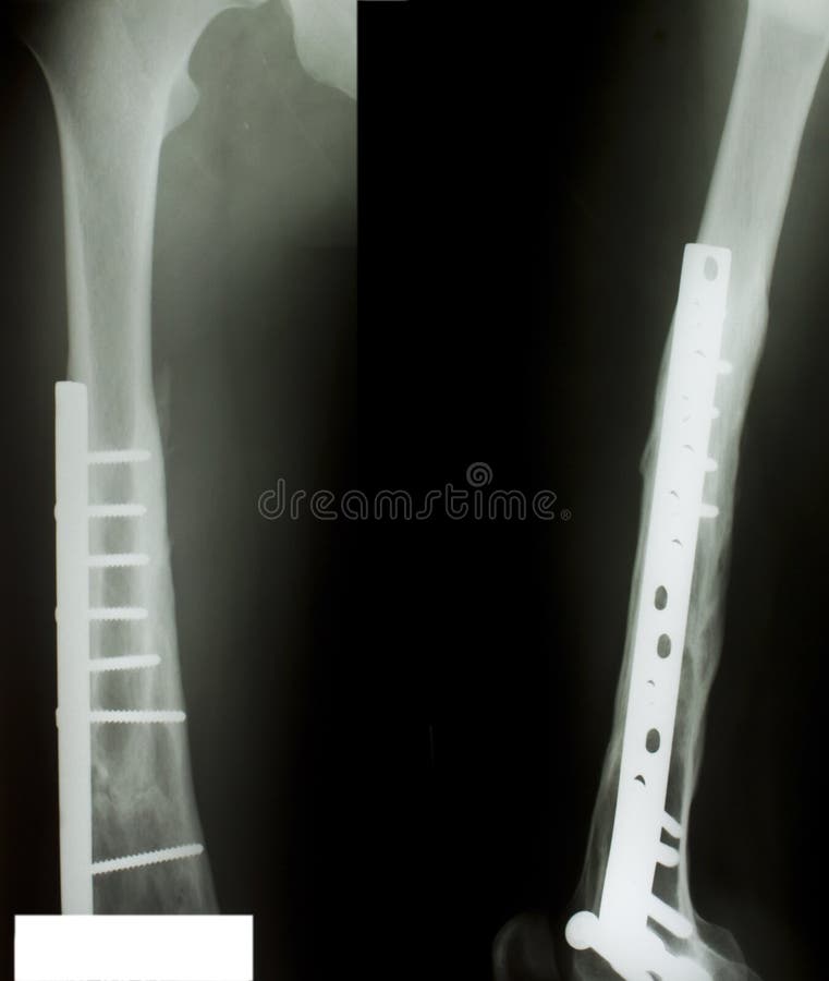 X-ray of Both Human Legs (broken Legs) Stock Photo - Image of body ...
