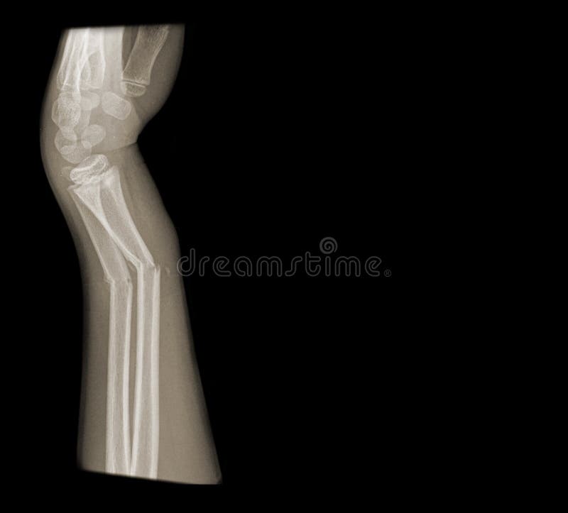 X-ray Of A Broken Arm Of A Child Stock Photo - Image: 14111630