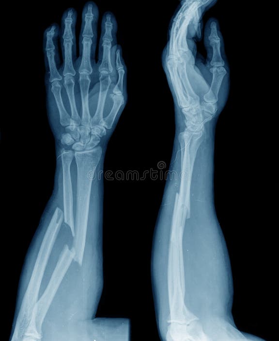 X-ray of broken arm stock photo. Image of condition, cast - 47702962