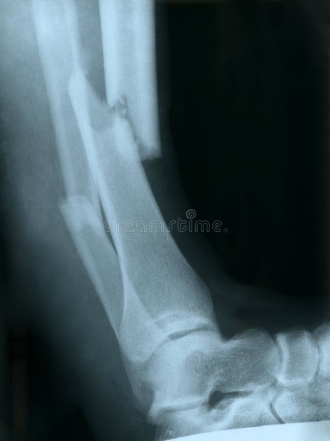 19,212 Broken Leg Photos - Free & Royalty-Free Stock Photos from Dreamstime