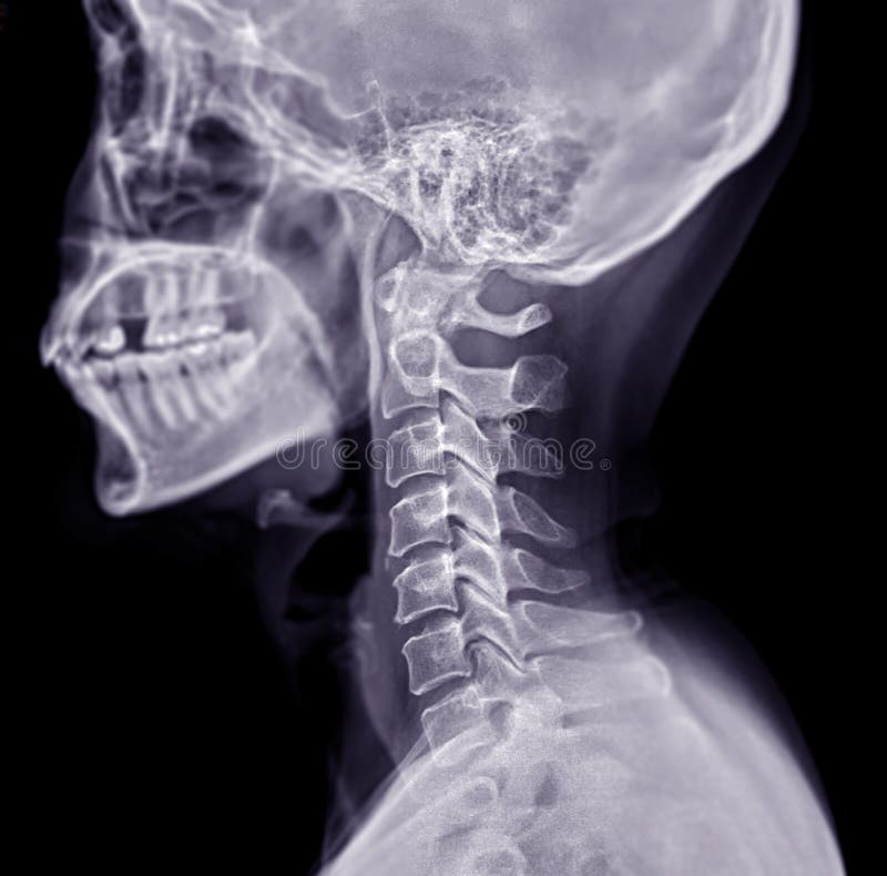 X-ray C-spine or X-ray Image of Cervical Spine Lateral View for ...