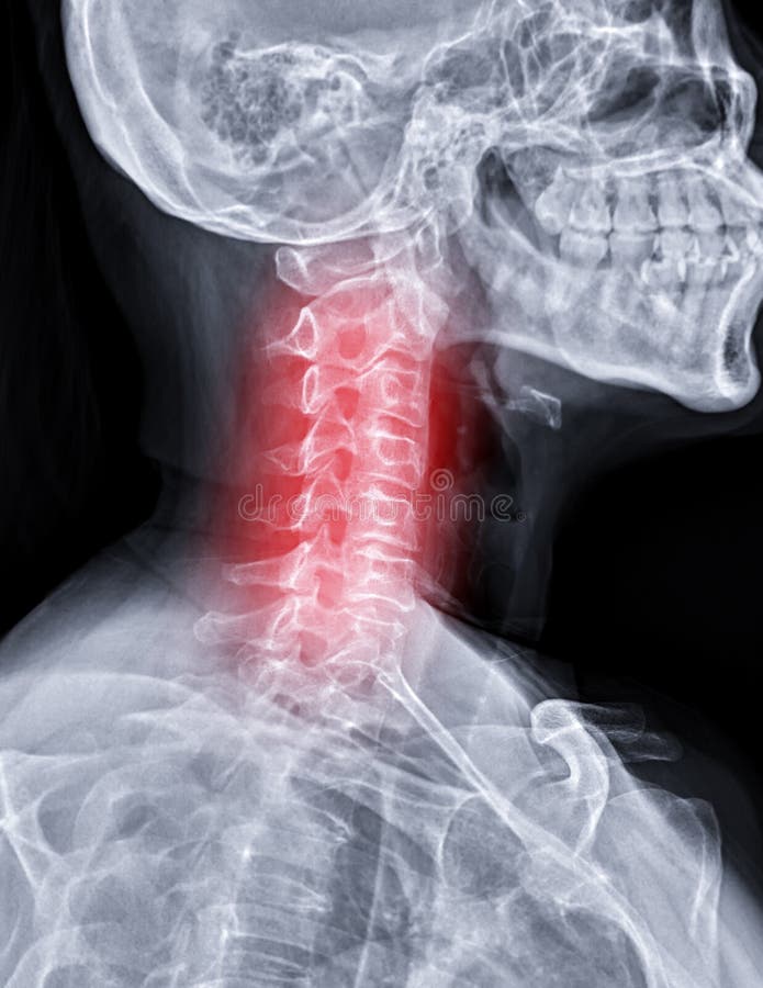 C-spine or X-ray Image of Cervical Spine AP and Lateral View Stock ...