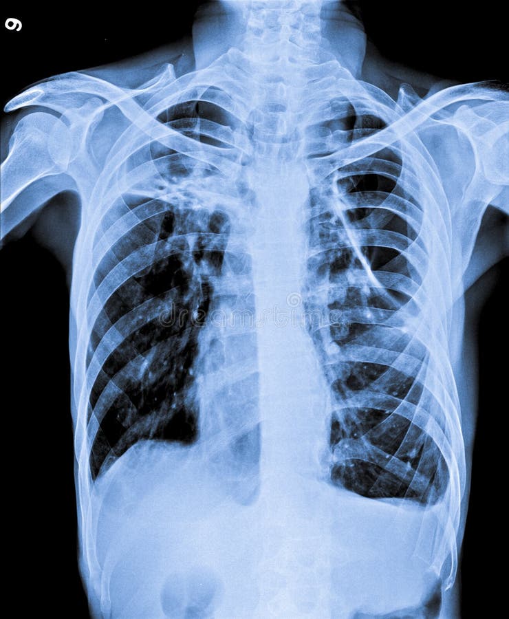 Left Lung Pneumothorax in Patient with Trauma Stock Image - Image of ...