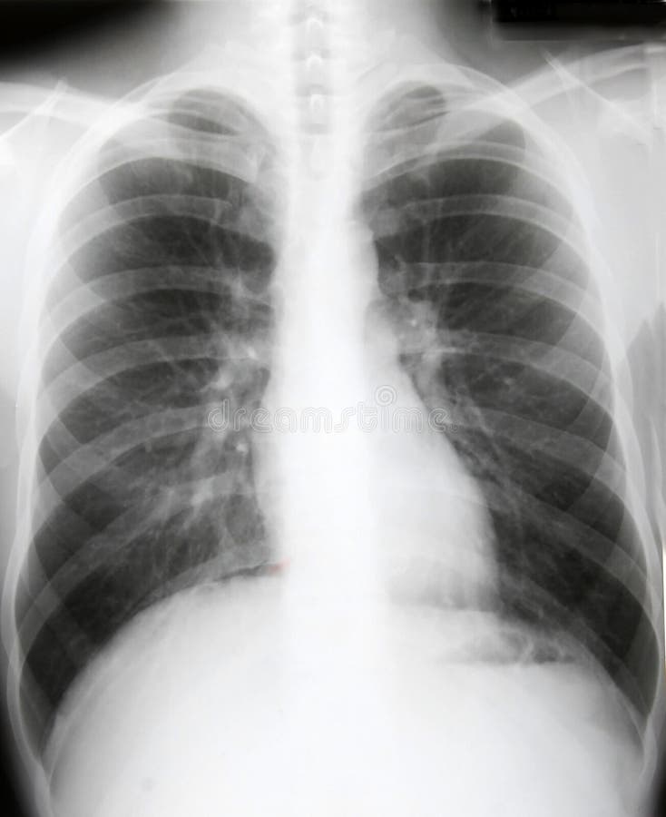 X-ray of chest of patient stock image. Image of clinic - 1798215