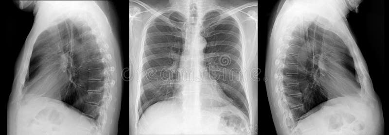 X-ray of the Chest of a 65-year-old Man in Three Projections Stock ...