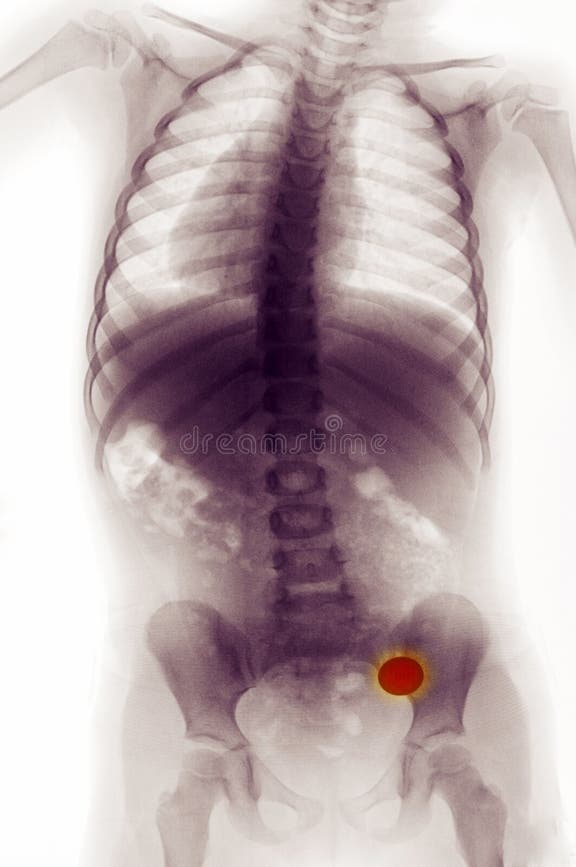 X-ray of Child Who Swallowed a Coin Stock Illustration - Illustration ...