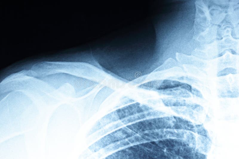 X-ray stock image. Image of neck, roentgen, radiography - 34132175