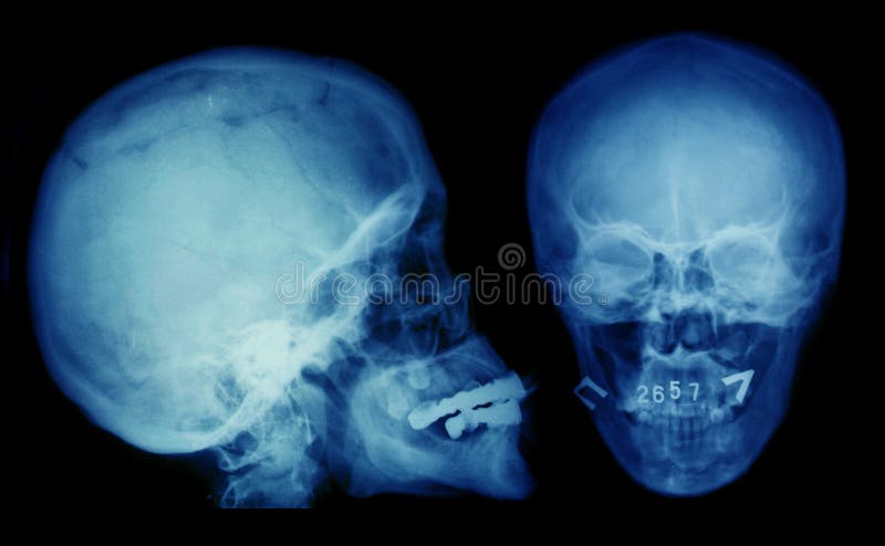 CT Scan of Human Skull and 3D Stock Photo - Image of neurosurgery ...
