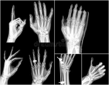 X Ray Middle Finger Stock Photos - Free & Royalty-Free Stock Photos ...