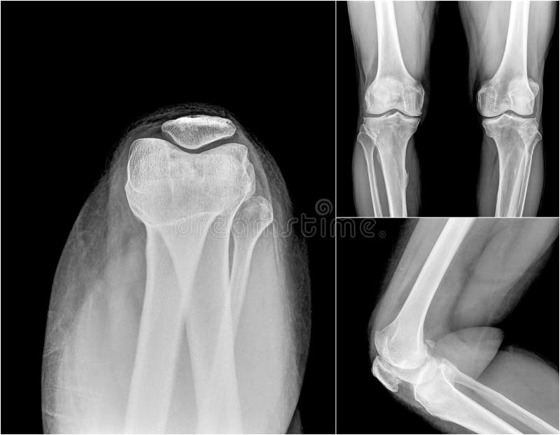 X-ray stock image. Image of joint, muscular, frustration - 54786047