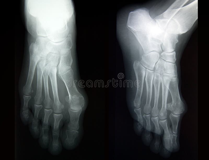 Plain Film X-ray, Radiography, of Complete Foot in Two Projections ...