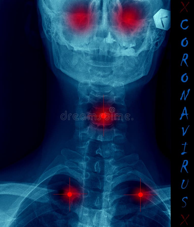X Ray of Corona Infected Person Stock Image - Image of infection ...