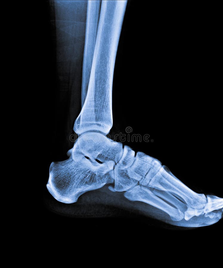 Articulación De Tobillo De Rayos X, Imagen Radiográfica O Imagen De ...