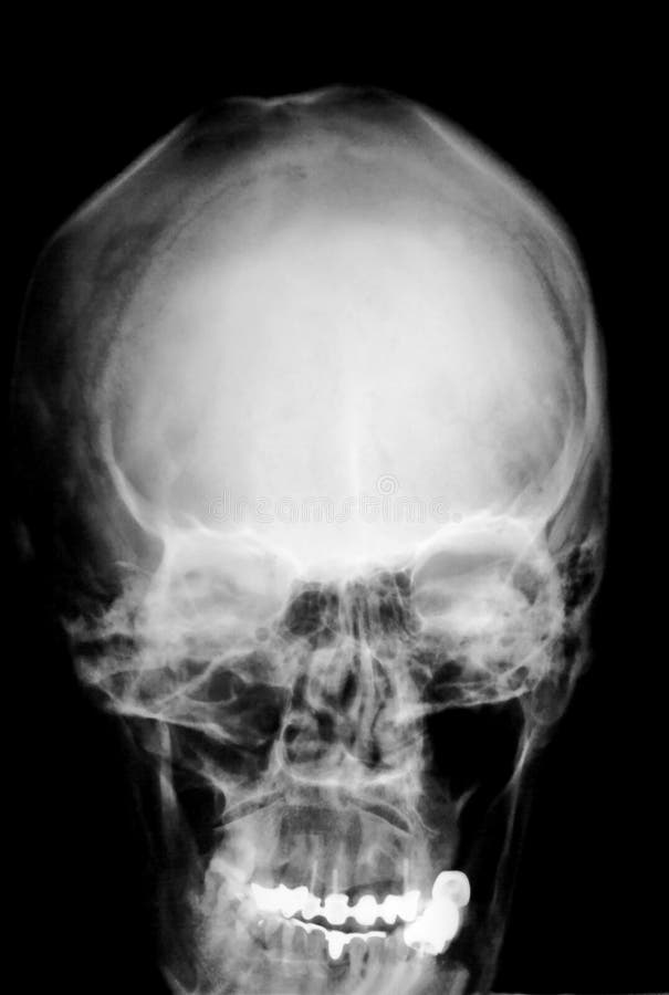 Skull xray stock photo. Image of examination, skeleton - 19001360