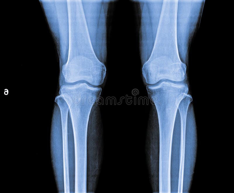 Articolazione Del Ginocchio Con Femore E Tibia Immagine Stock ...