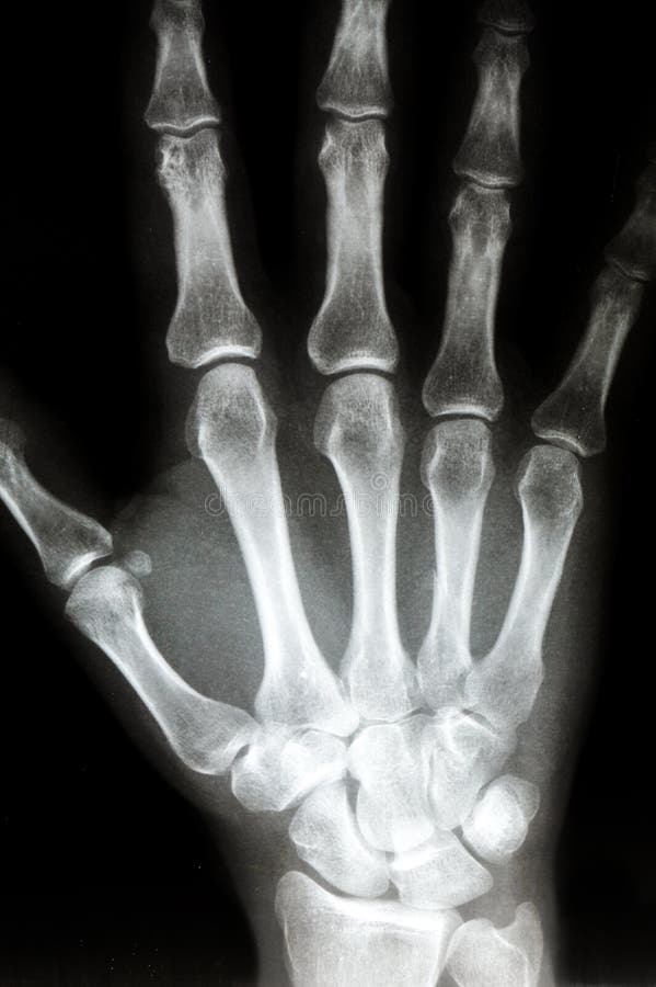X Ray della mano destra fotografia stock. Immagine di paziente - 53096640