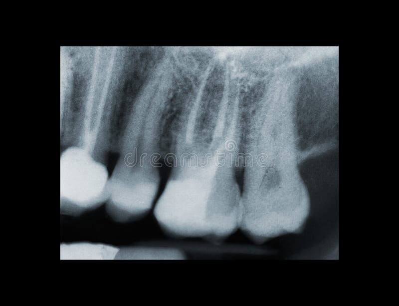 Real X-ray of Devitalized Tooth. X-ray of Root Canal Treatment Tooth ...