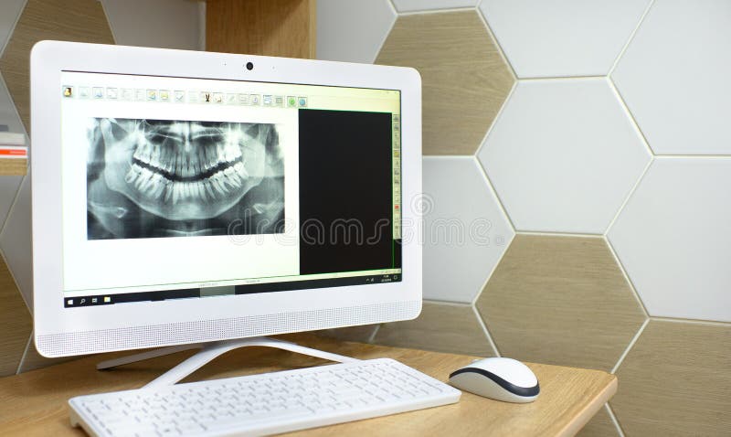 X-ray in Dentistry Snapshot of a Tooth. Computer Monitor Stock Image ...