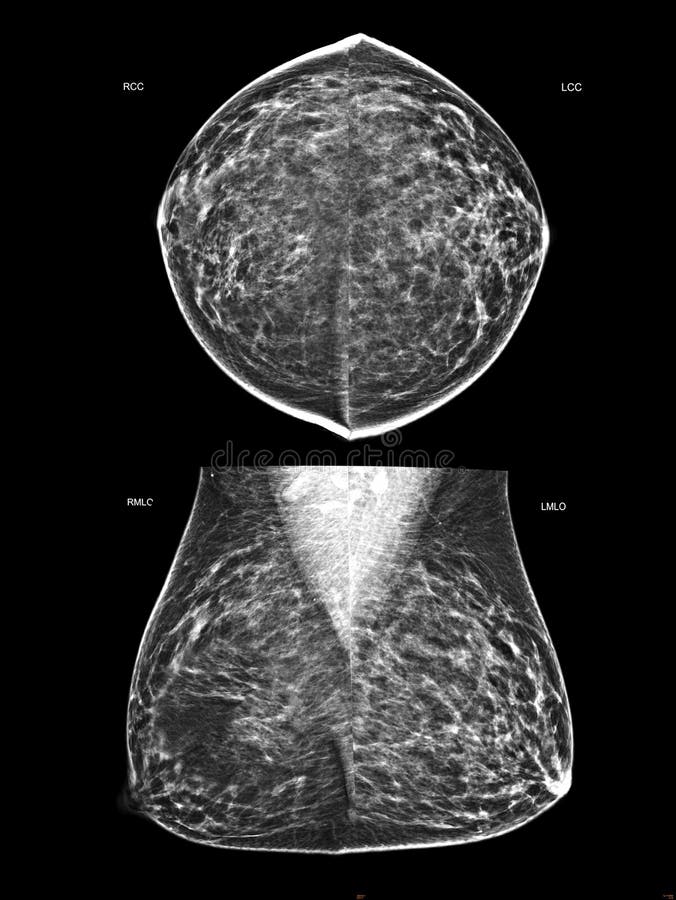 X Ray Digital Mammogram Or Mammography Of Both Side Breast Standard