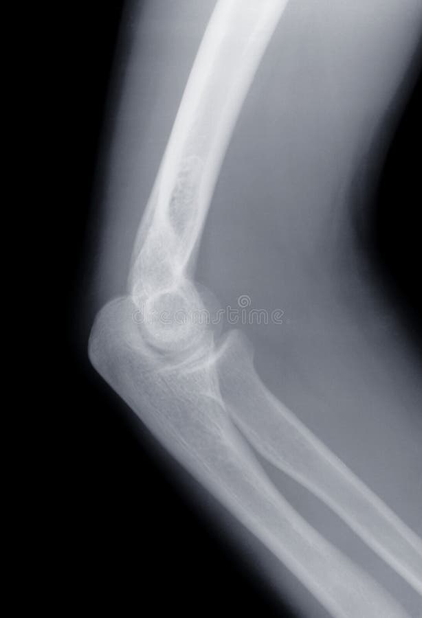 Film X-ray Elbow AP(Antero-posterior)/lateral Stock Image - Image of ...