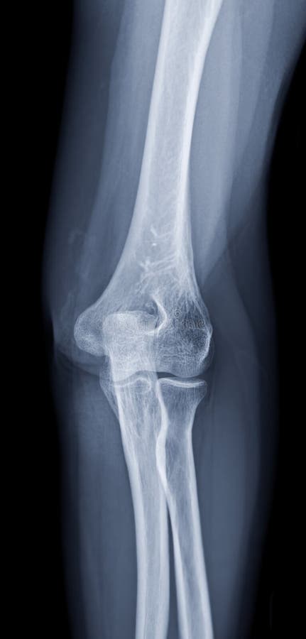 X-ray of Elbow Join Showing Normal Elbow Joint Stock Image - Image of ...