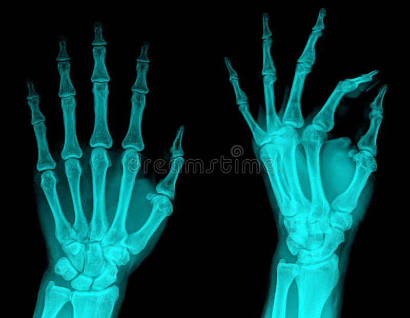 X-Ray stock photo. Image of medical, health, finger, hospital - 54683560